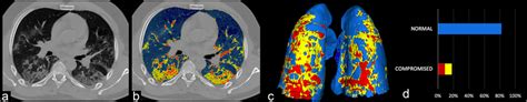Quantitative Lung CT Analysis Of A 35 Year Old Male Patient Affected By