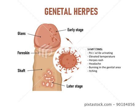 Genital Herpes Herpes Simplex Virus Stock Illustration 90184856
