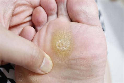 Foot Corns And Callus Leading Health Podiatry