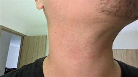 How Do You Prevent Razor Burn Shaven Theory