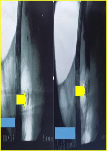 Ercp Before Left Picture And After Right Picture Contrast Agent
