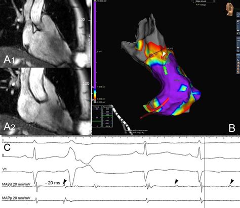 Low Voltage Areas 35 Years Old Female Patient 48 Showing Abnormal Download Scientific