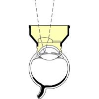Ocular Abraham Iridectomy Yag