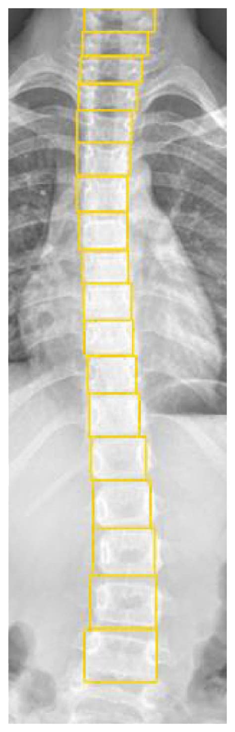 Detection Of Vertebrae A Central Spinal Curve Line B Spine