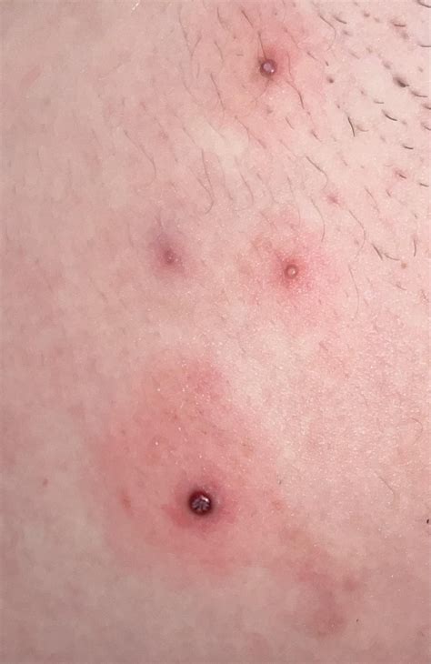 Molluscum Treatment Podophyllum Resin Podofilox Anyone Has Experience With This R Molluscum