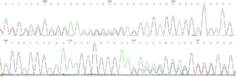 Electropherogram Of The Mutation In Patient No 3 Download