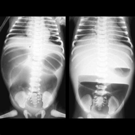 Jejunal Atresia Pediatric Radiology Reference Article Pediatric