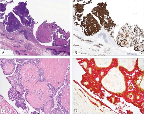 Papillary Neoplasms Of The Breast Including Upgrade Rates And