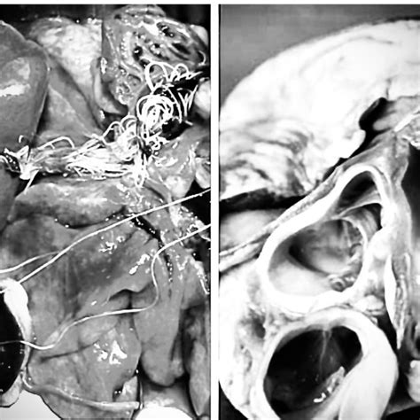 St Periventricular Nodular Heterotopia