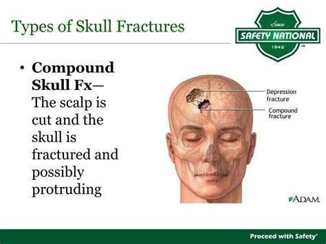 Types Of Skull Fracture Stylesstorm