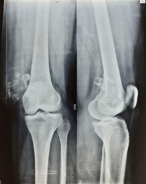 Chondroma In Knee X Ray