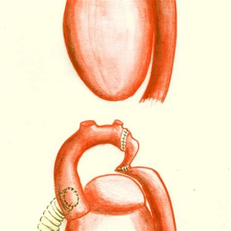 Extra Anatomical Bypass Of Aortic Coarctation Download Scientific Diagram