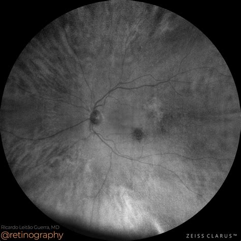 Choroidal Nevus Retinography
