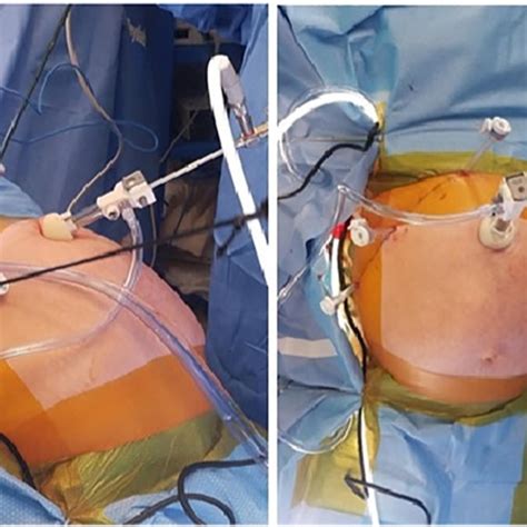 Laparoscopic Port Placement Noting Superior Placement Of 10 Mm Hasson
