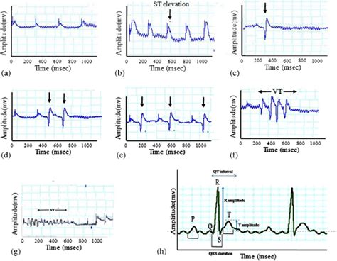Examples Of Electrocardiogram Recordings And Definition Of Various Download Scientific Diagram