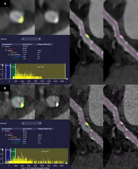 Frontiers First In Human Quantitative Plaque Characterization With