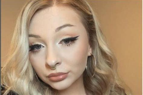 Devojka Boluje Od Psorijaze