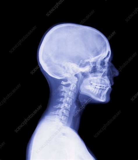 Human Head X Ray Stock Image C0078674 Science Photo Library