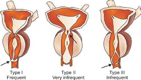 Posterior Urethral Valves Diagram Pediatric Urology Glossary Atlanta