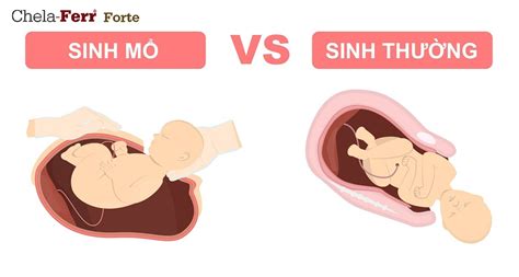 Dấu Hiệu Nhận Biết Sinh Thường Hay Sinh Mổ