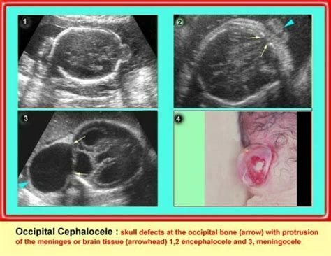 Cephalocele Department Of Obstetrics And Gynecology Faculty Of