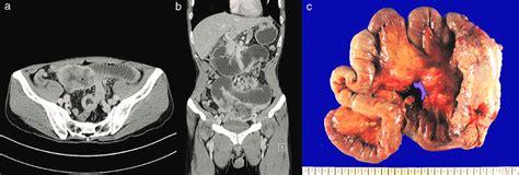 Abdominal Computed Tomography Ct Scan Revealed Multiple Polypoid Download Scientific Diagram