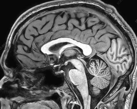 Normal Brain Mri Medial View Stock Image C0305645 Science