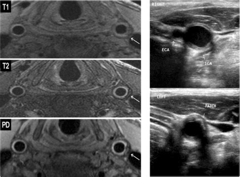 Patient With Bilateral Carotid Endarterectomy Five And A Half Years
