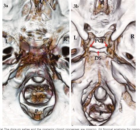 Structure Of Posterior Clinoid Process Semantic Scholar