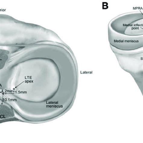 Illustrations Of The Meniscal Root Tear Classification System In My Xxx Hot Girl