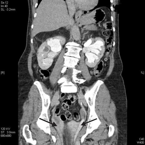 Hydronephrosis X Ray