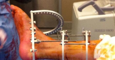 Lower Leg Halo Ankle Dislocation And Achilles Tendon Lengthening