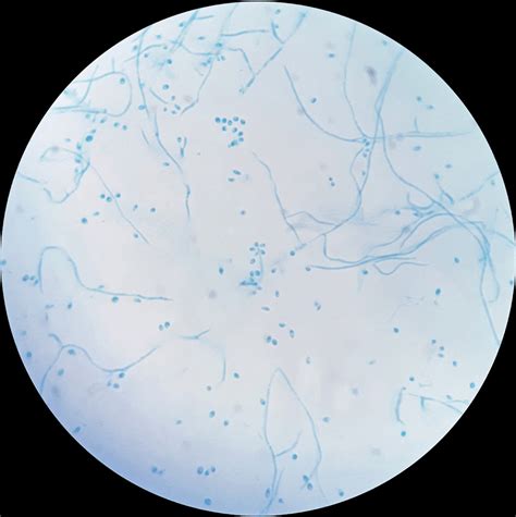 S Schenckii Lactophenol Cotton Blue Stain Microscopy At 1000×