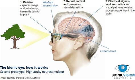 Bionic Eye Bionic Implants