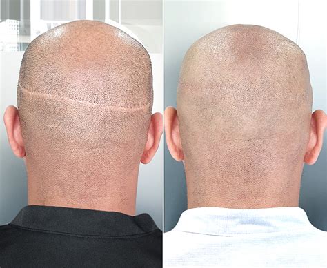 Hair Transplant Before And After Scar