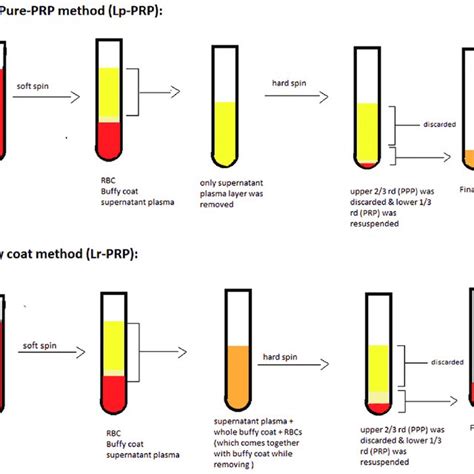 Comparison Of Platelet Yield Between Pure Prp Leukocyte Poor