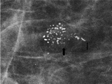 Spot Magnification Mammogram Cluster Of Amorphous Cal Cifications Download Scientific Diagram