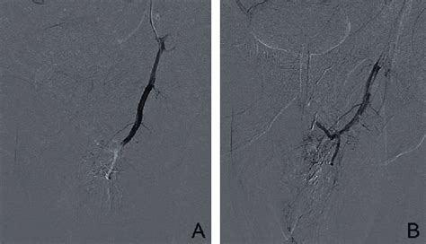 A B Post Embolization Arteriogram Shows A Completely Embolized Left Download Scientific
