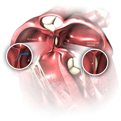 Pfo Occluder Occlutech Perfecting Performance