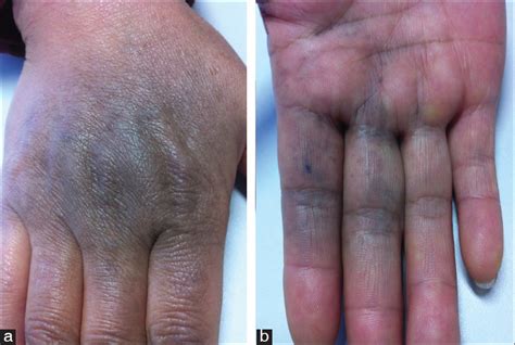 Congenital Dermal Melanocytosis