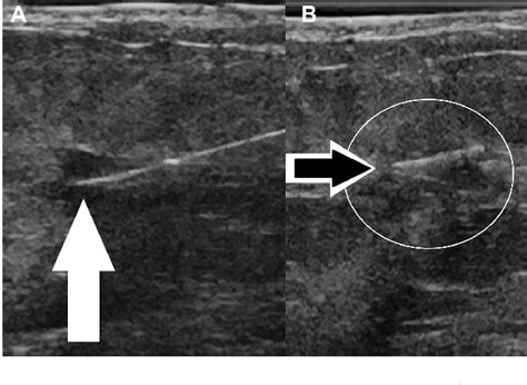 Figure 1 From Reflector Localization Of Breast Lesions And Parameters Associated With Positive