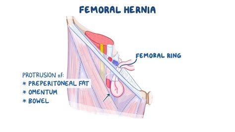 Video Femoral Hernias Clinical Sciences Osmosis