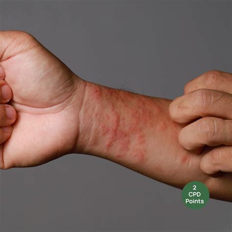 Clinical Care Platform On Linkedin Cutaneous Adverse Drug Reactions