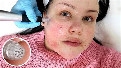 I Tried Microneedling For Acne Scars Youtube