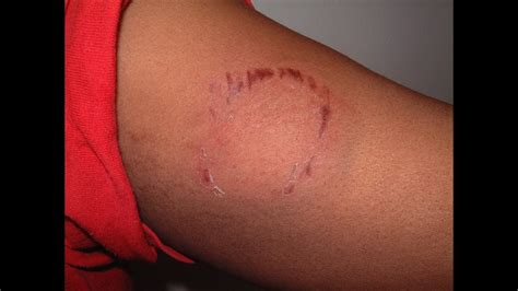 Human Bite Marks On Skin