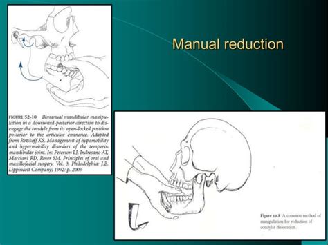 Tmj Dislocation And Its Managementpptx