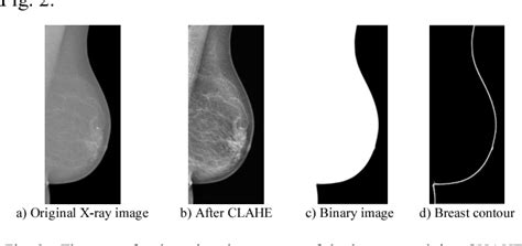 Figure 1 From Geometry Based Pectoral Muscle Segmentation From Mlo