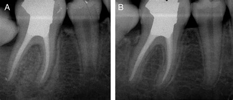 Histologic Examination Of Condensing Osteitis In Cadaver Specimens