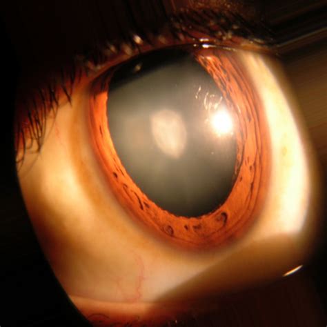 Cataract Object Detection Dataset By Siams Workplace
