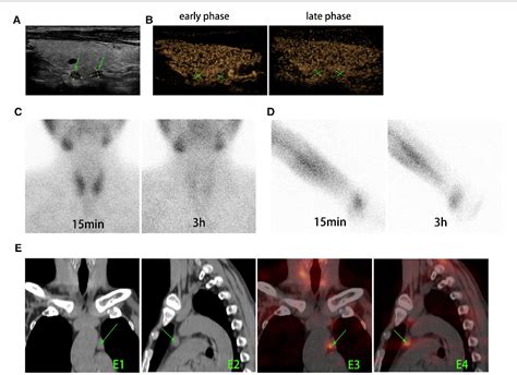 Figure 1 From Recurrent Renal Secondary Hyperparathyroidism Caused By